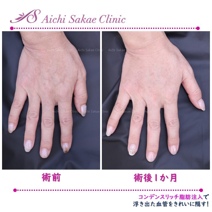 脂肪注入で若々しい手に（その他の美容整形）の症例写真 (CS64107)｜あいち栄クリニック《美容医療の口コミ広場》