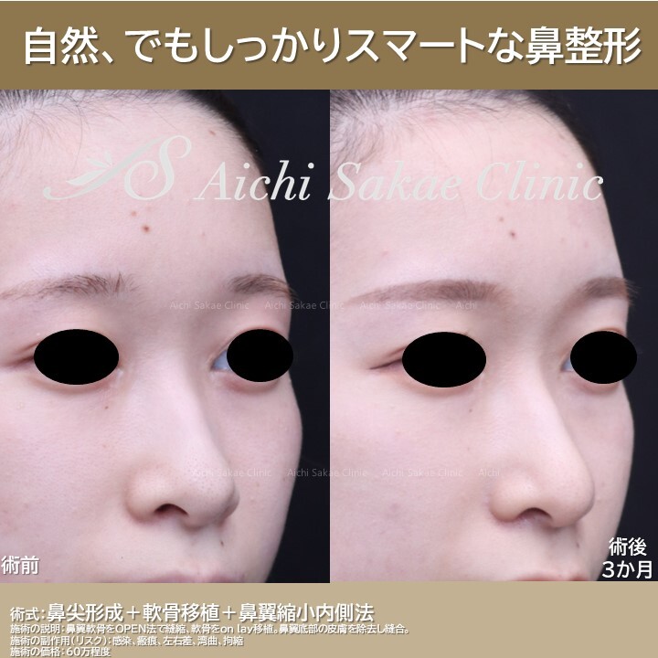 鼻の手術はあいち栄クリニックへ 鼻の整形の症例写真・画像 あいち栄クリニック Cs71399 《美容医療の口コミ広場》