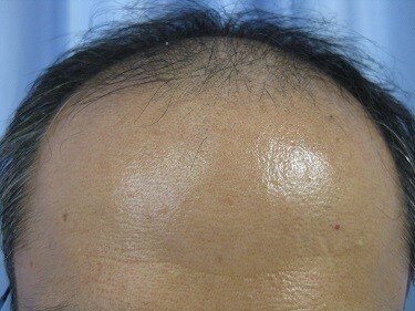 [50代 男性] HARG療法（HARG療法）の症例写真 (CS54003)｜札幌中央クリニック《美容医療の口コミ広場》