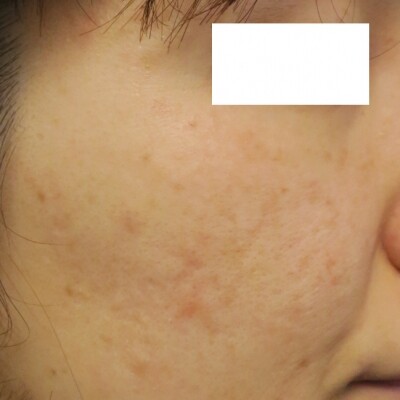 シミ治療（フォトBBL+スポットチップ+イオン導入） (フォトフェイシャルの症例写真・画像) - メディアージュクリニック 青山院 ...