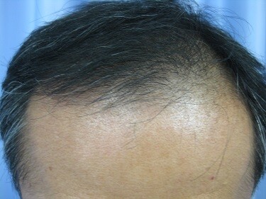 [50代 男性] HARG療法（HARG療法）の症例写真 (CS54003)｜札幌中央クリニック《美容医療の口コミ広場》