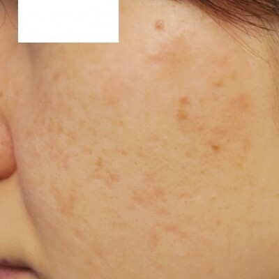 [30代 女性] シミ治療（フォトBBL+スポットチップ+イオン導入）（レーザートーニング）の症例写真 (CS13532)｜メディアージュ ...