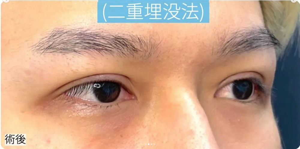 1dayルラライン (目・二重整形の症例 - ルラ（LULA）美容クリニック) (CS71293)《美容医療の口コミ広場》