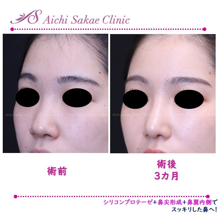 鼻の手術はあいち栄クリニックへ 鼻の整形の症例写真・画像 あいち栄クリニック Cs70232 《美容医療の口コミ広場》